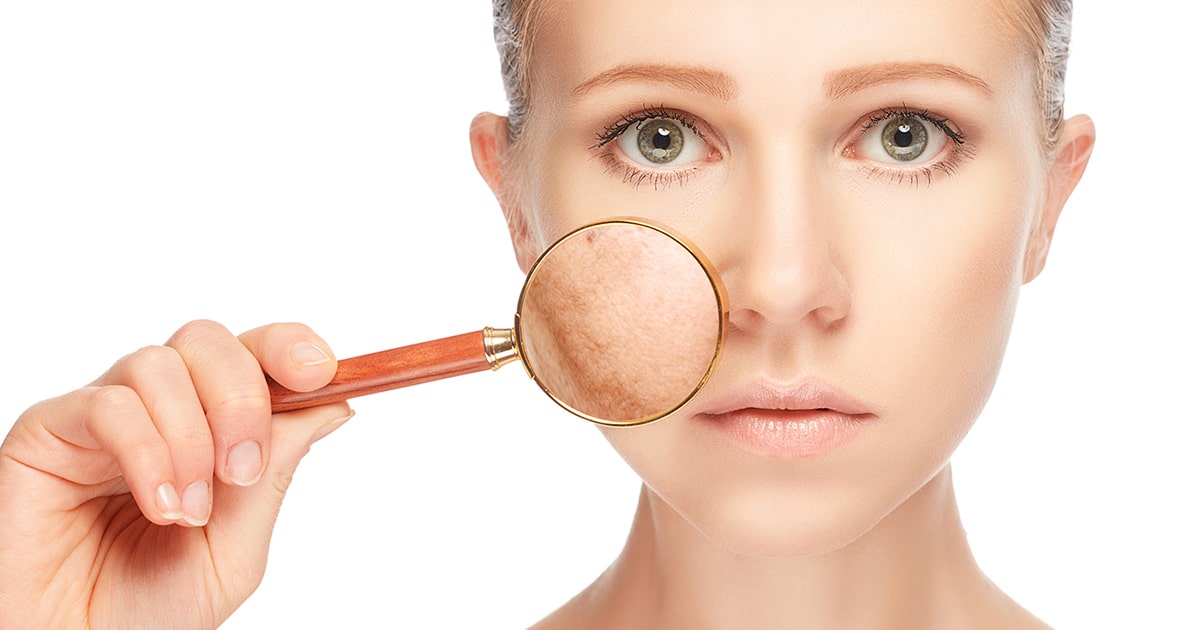 PCOS Hormonal Acne: 5 Ways to Treat It